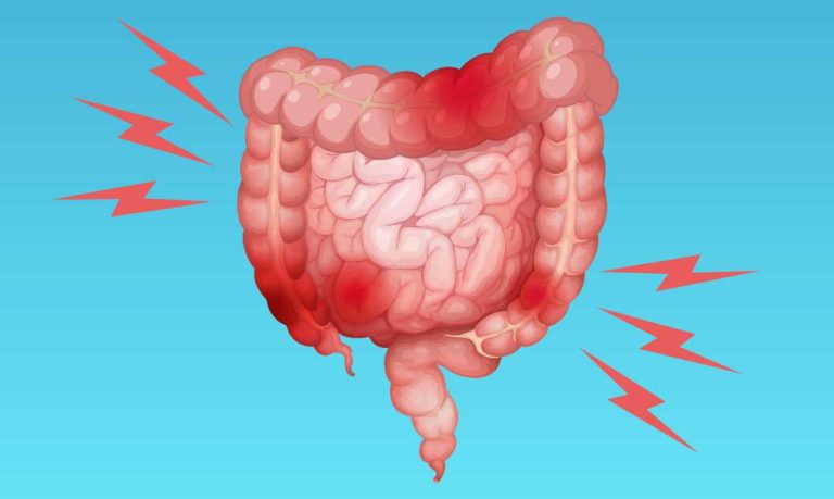 Enfermedad inflamatoria intestinal - Yakult en Puebla